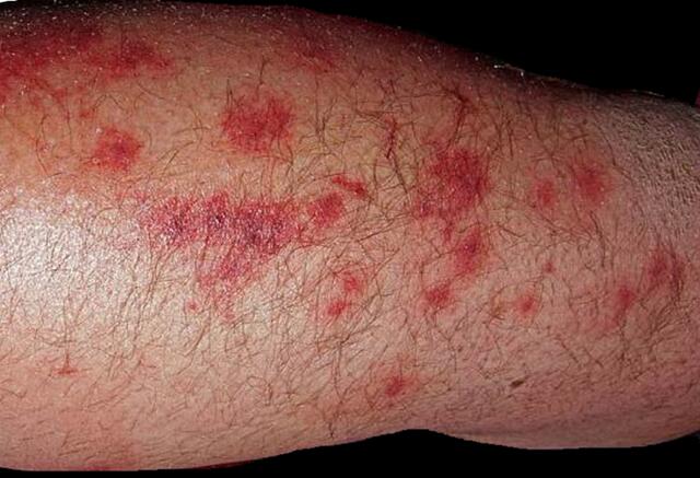 Sommer der Vampire: Blutsauger mit "scharfen Zähnen" - Essen